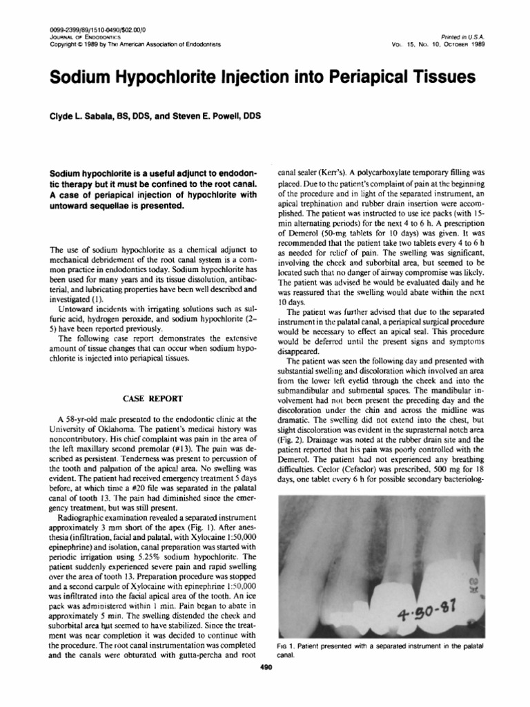 Sodium Hypochlorite Injection Into Periapical Tissues Sambala 1989 ...
