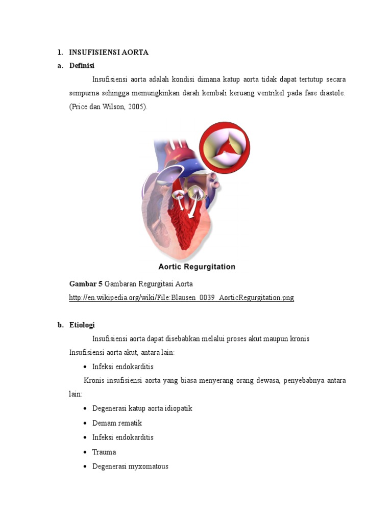 Insufisiensi Aorta | PDF