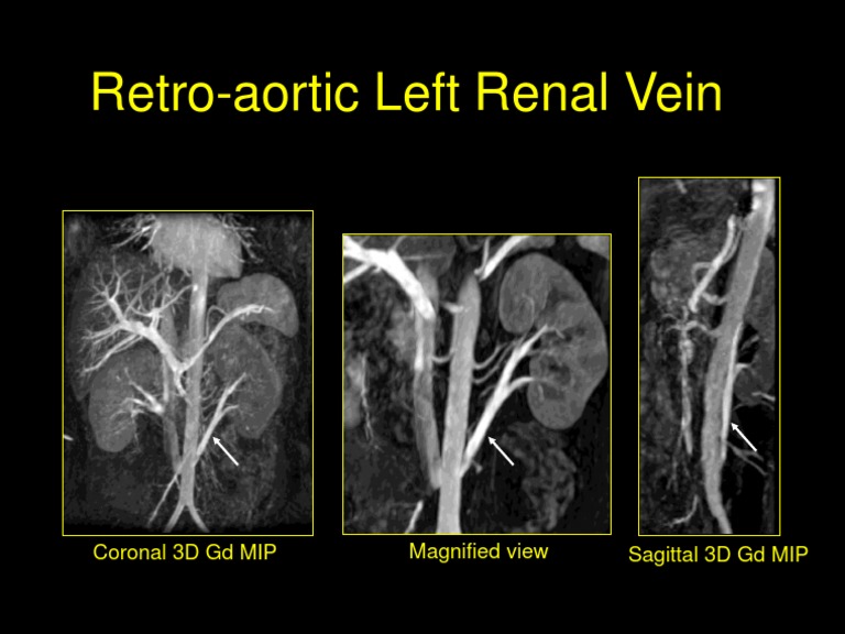 Retroaortic Renal Vein | PDF