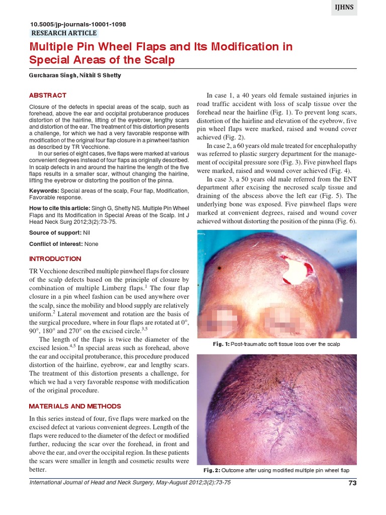 Multiple Pin Wheel Flaps and Its Modification in Special Areas of The ...