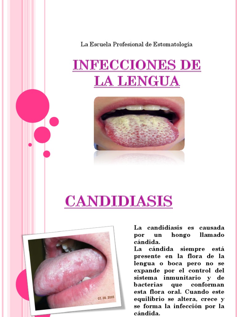 Infeccion de La Lengua Patologia