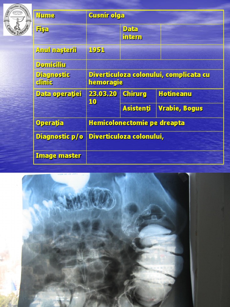 Diverticuloza Colonica | PDF