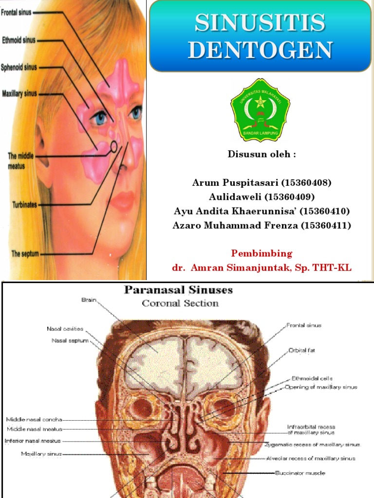 Sinusitis Dentogen: Gejala dan Penanganan | PDF | Kajian Bahasa Asing ...