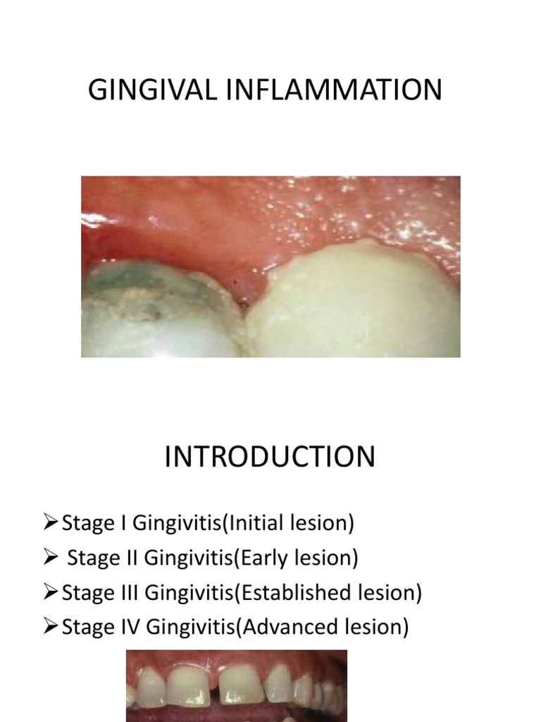Stages of Gingival Inflammation | PDF | Inflammation | White Blood Cell