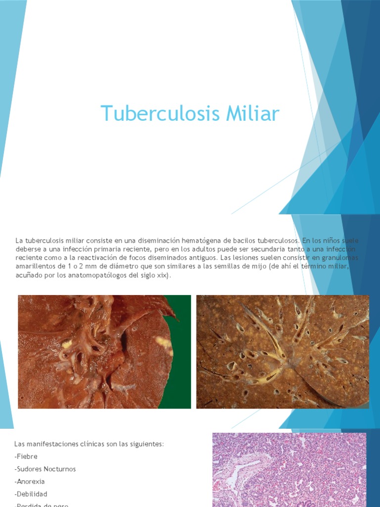 Manifestaciones clínicas y físicas de la tuberculosis miliar: una ...