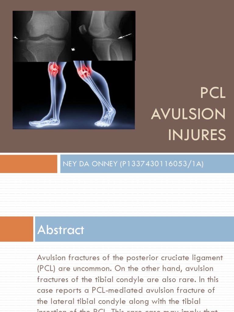 Pcls Avulsion Fracture Knee Human Anatomy