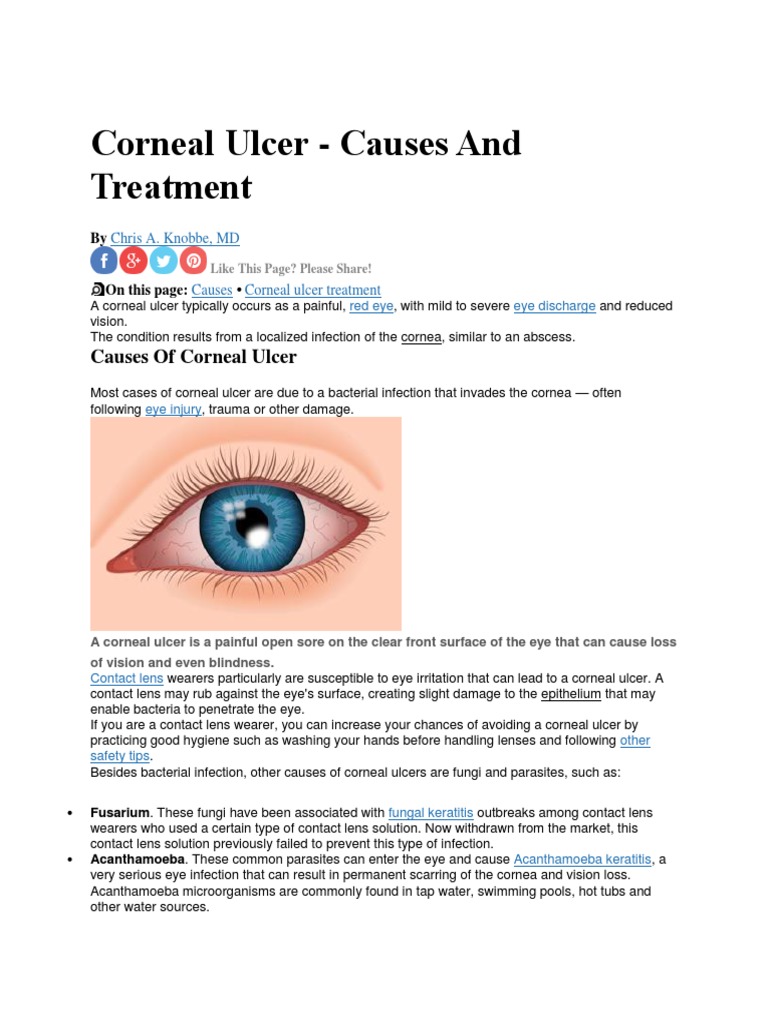 Corneal Ulcer | Contact Lens | Cornea