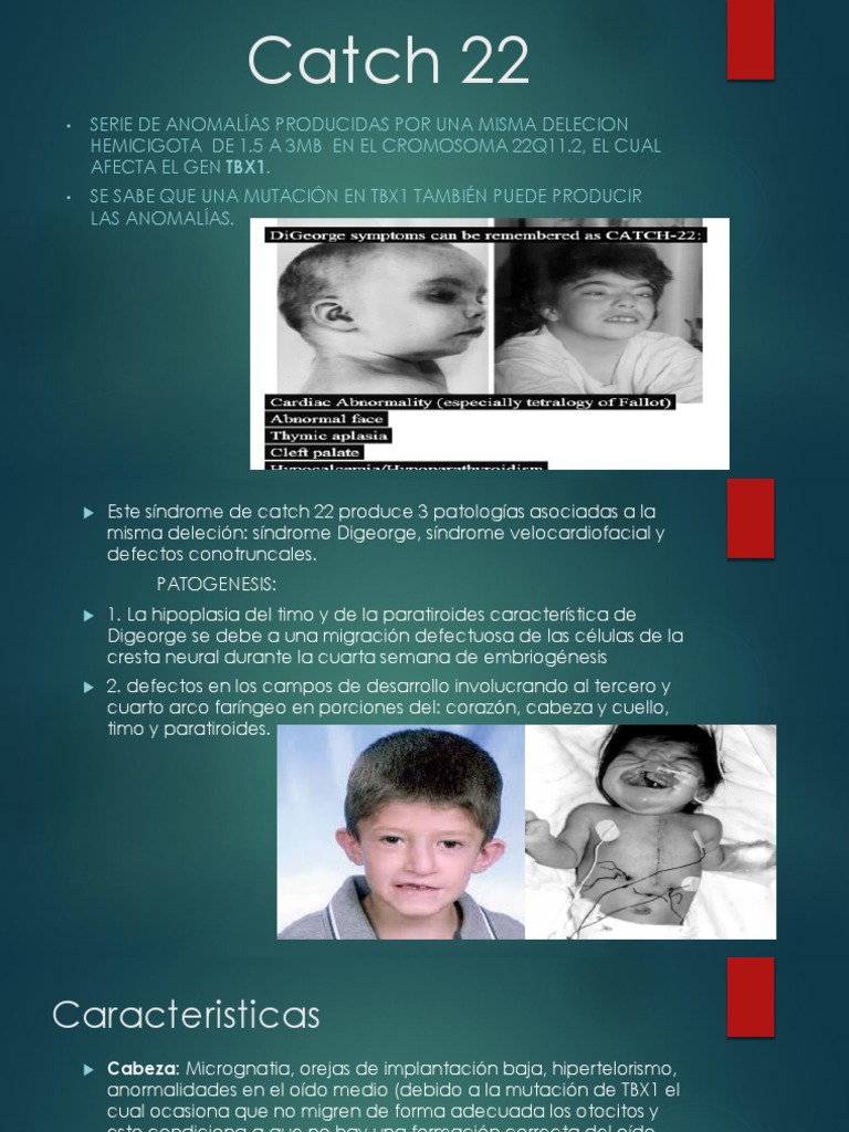 Síndrome de DiGeorge y Catch 22 | PDF | Timo | Mutación