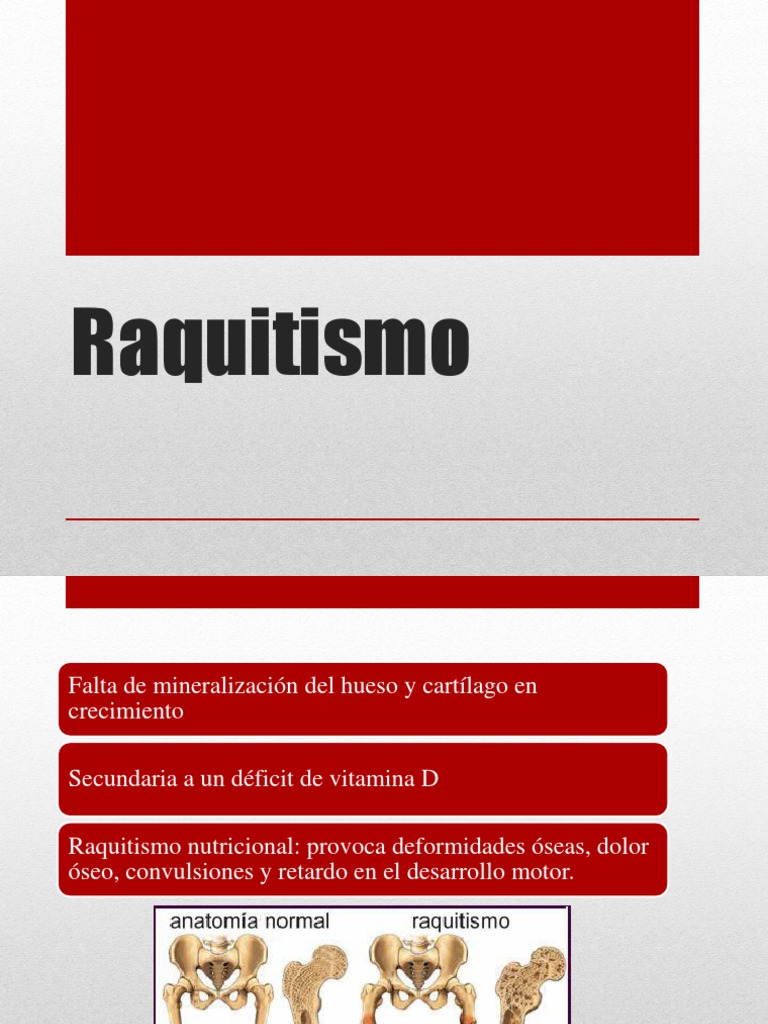 Raquitismo | Vitamina D | Nutrición