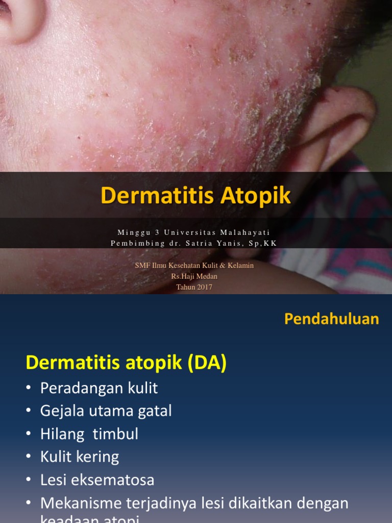 Dermatitis Atopik | PDF | Griya & Taman | Kesehatan Holistik