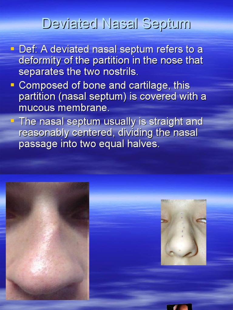 Understanding Deviated Nasal Septum | PDF | Human Nose ...