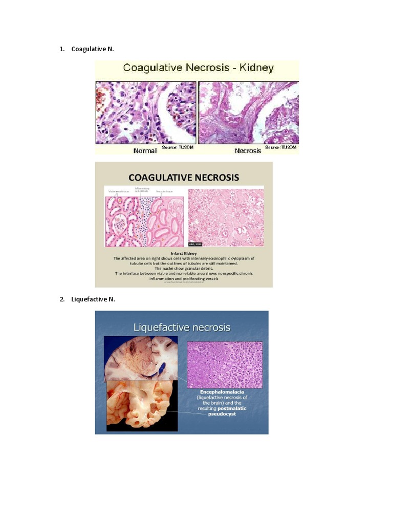 Types of Necrosis in Pathology | PDF