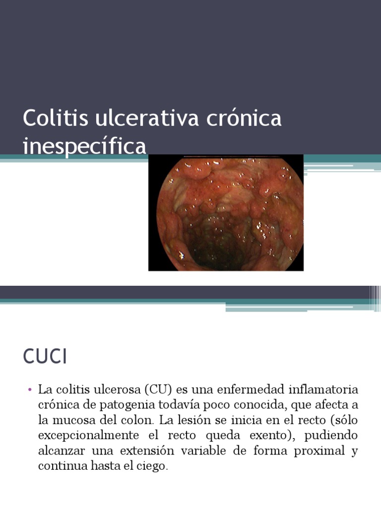Colitis Ulcerativa Crónica Inespecífica | PDF | Medicina CLINICA ...