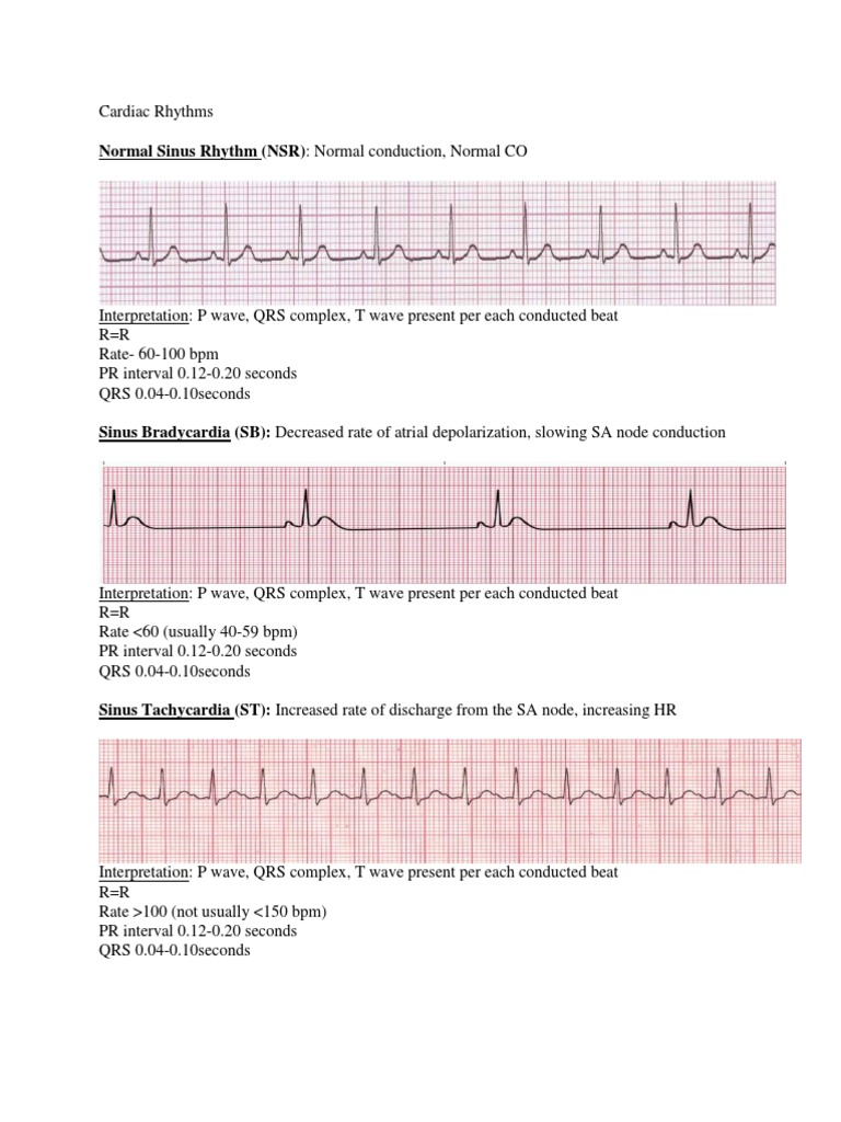 Cardiac Rhythms (3) | Electrophysiology | Cardiac Arrhythmia