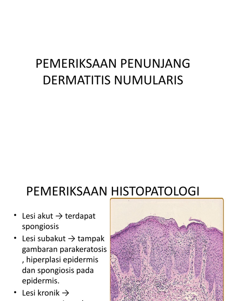 Pemeriksaan Penunjang Dermatitis Numularis | PDF