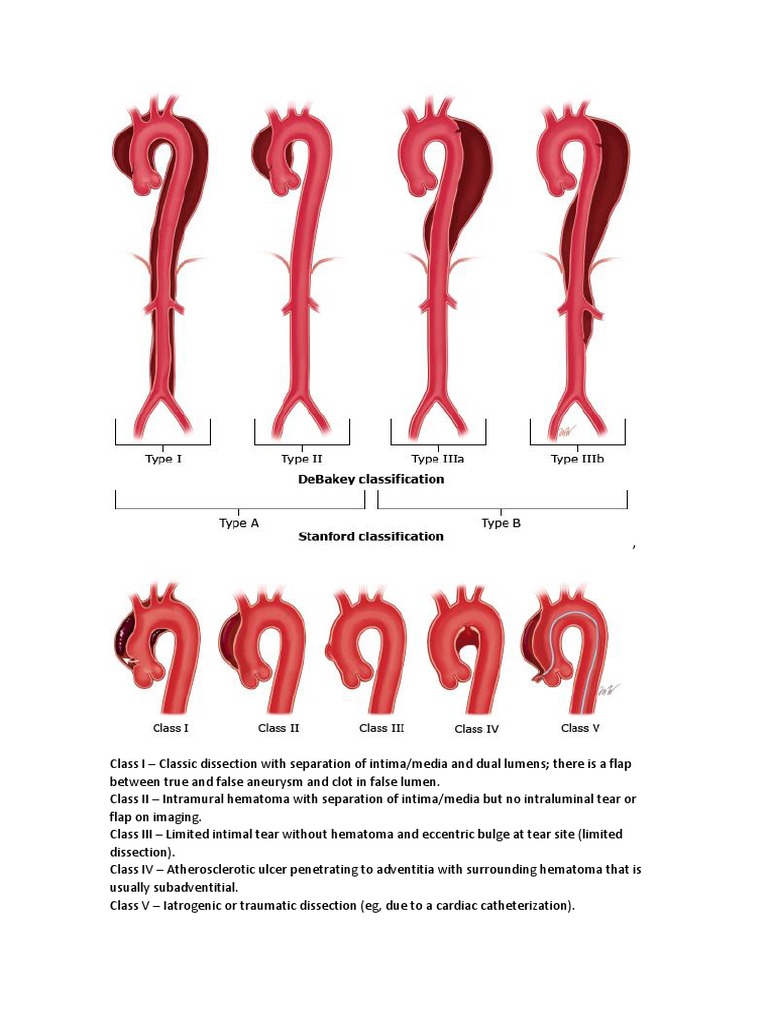 Aortic Dissection | PDF | Aorta | Coronary Artery Bypass Surgery