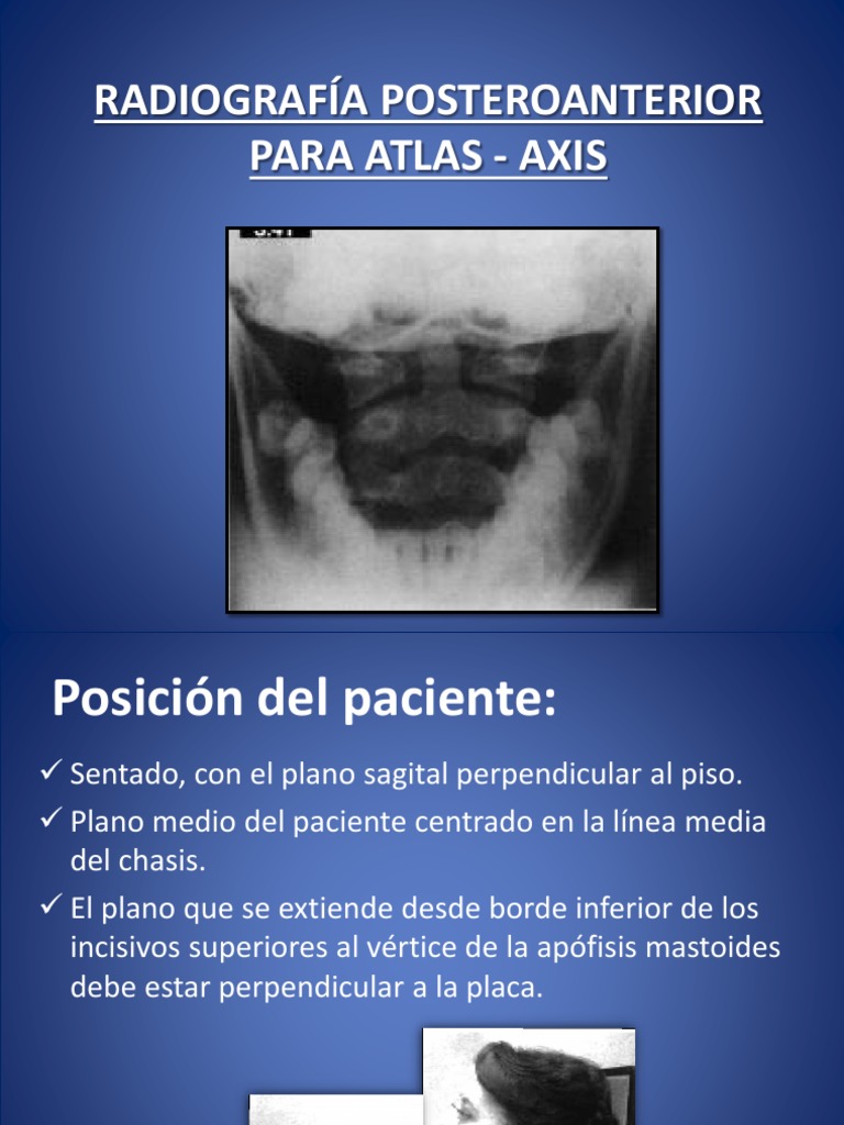 Radiografía Posteroanterior para Atlas - Axis | PDF