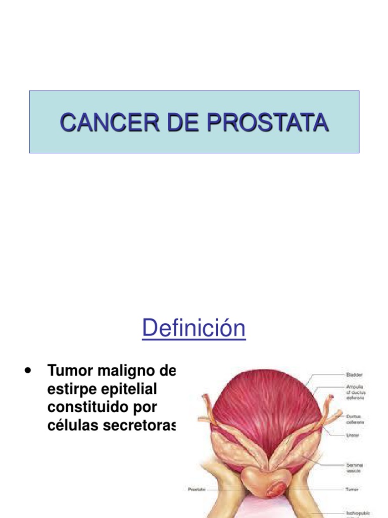Cáncer de Próstata: Diagnóstico y Tratamiento | PDF | Antígeno ...