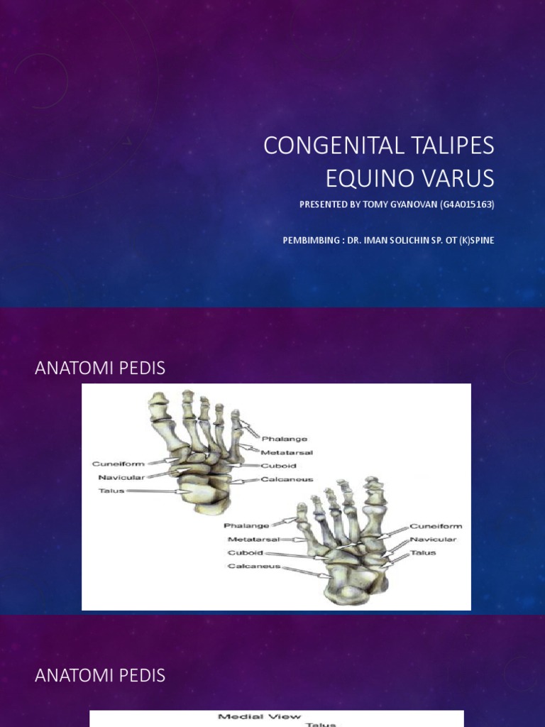 Congenital Talipes Equino Varus | PDF