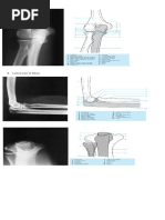 Fraktur Antebrachii | PDF
