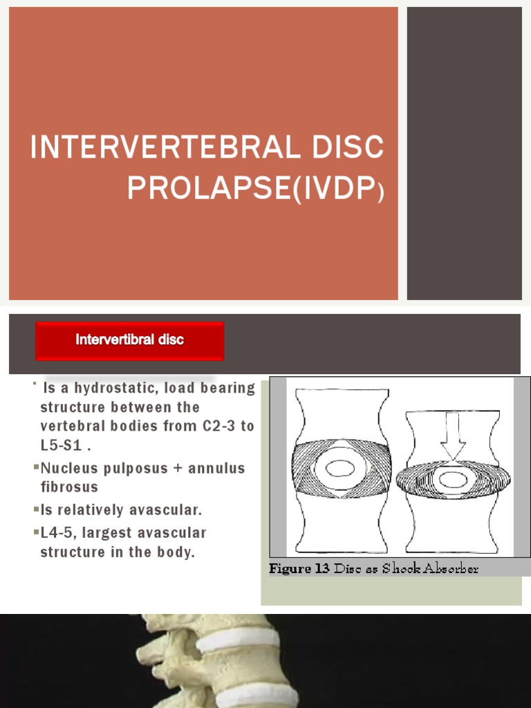 Intervertebral Disc Prolapse (Ivdp) | PDF | Vertebral Column | Nervous ...