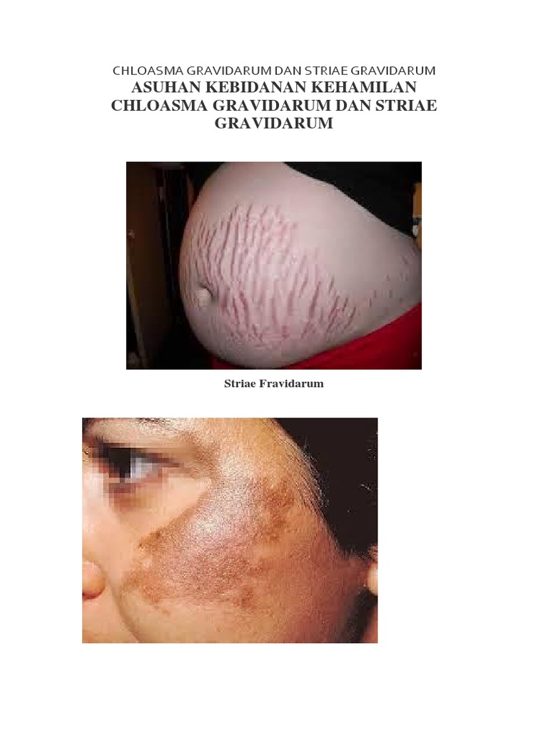 Chloasma dan Striae Gravidarum pada Ibu Hamil | PDF | Sains & Matematika