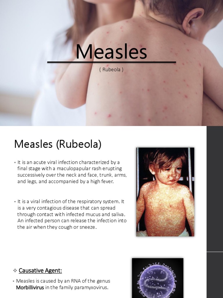 Measles (Case Presentation) | PDF | Measles | Infection