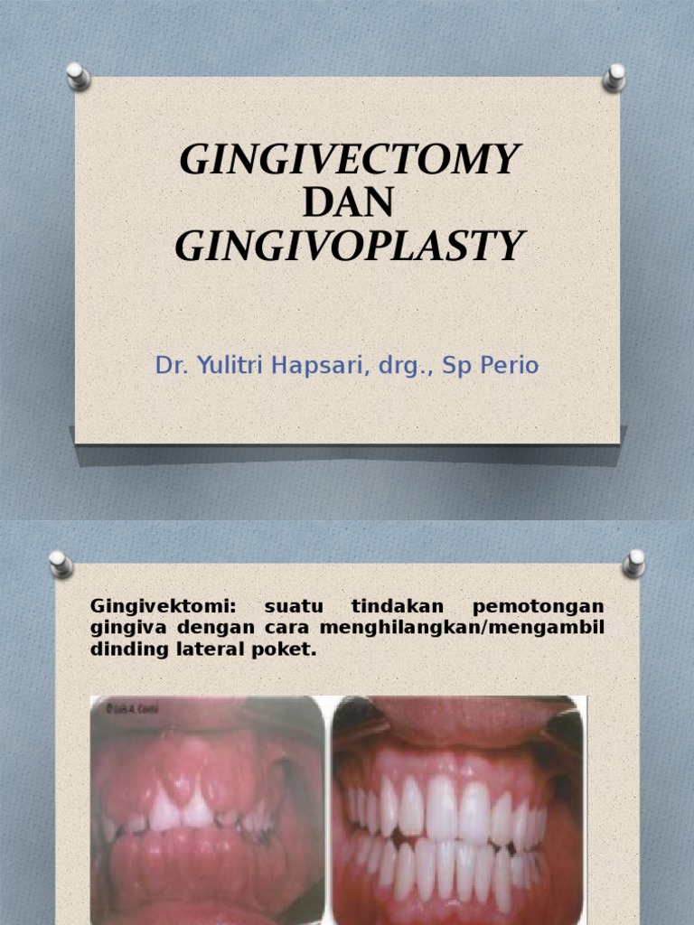 Gingivectomy Dan Gingivoplasty PP | PDF