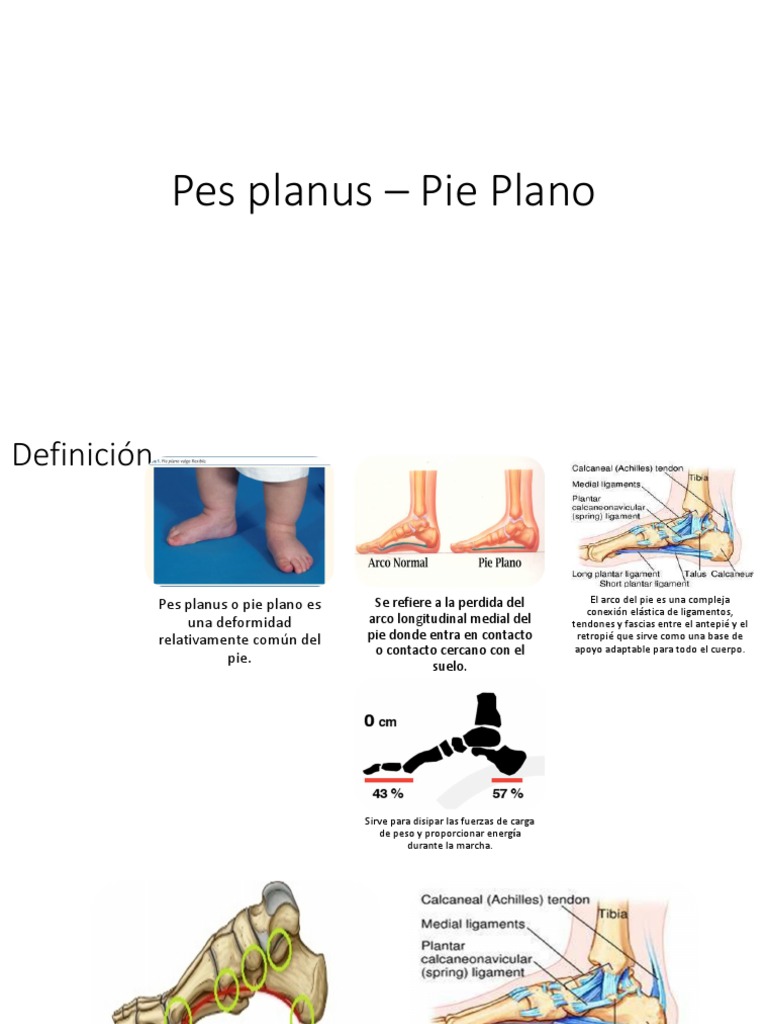 Pes Planus – Pie Plano