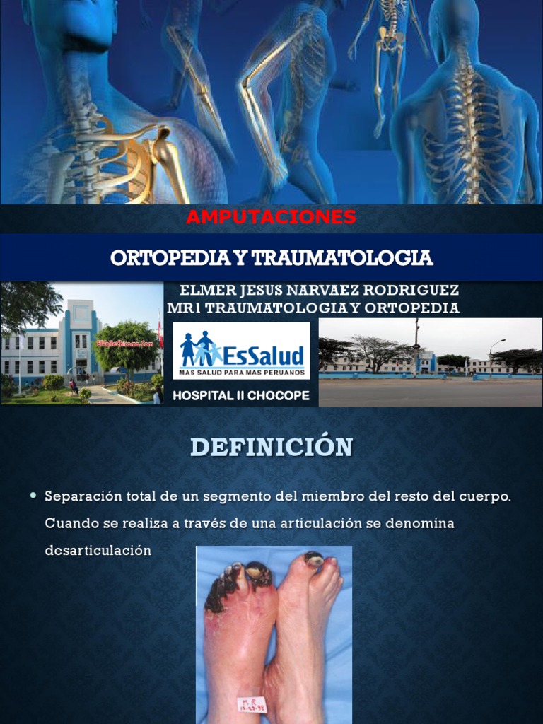 amputaciones.pptx | Dedo del pie | Pie | Prueba gratuita de 30 días ...