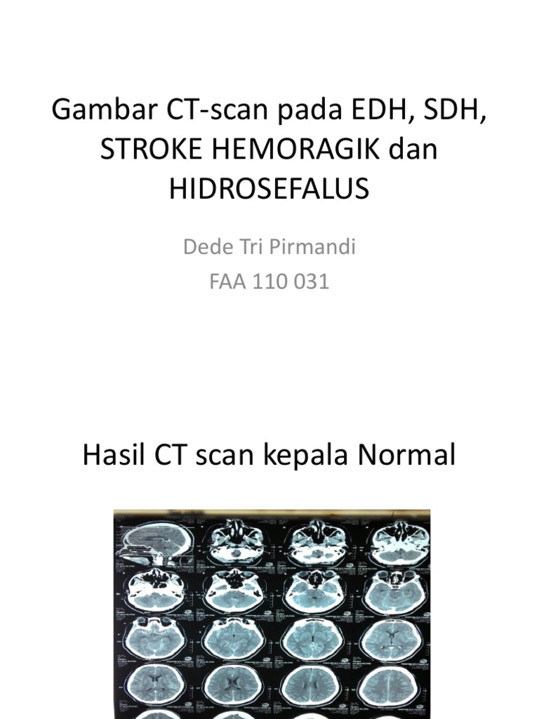 Gambar Ct-Scan Pada Edh, SDH, Stroke | PDF