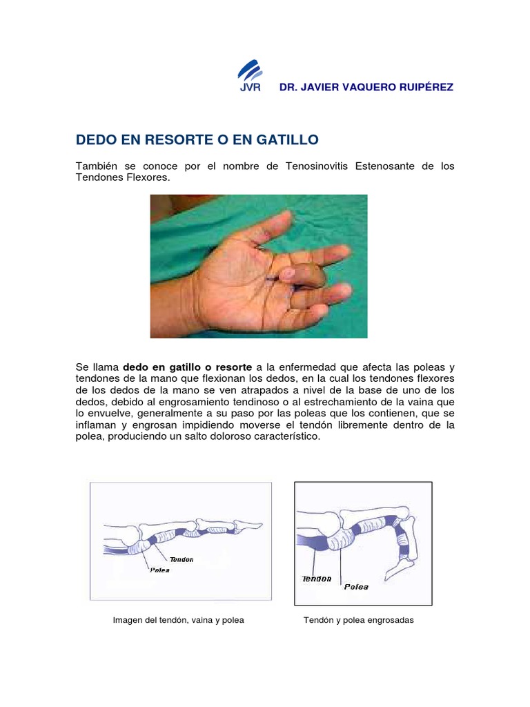 Dedo en Resorte: Causas y Tratamiento | PDF | Mano | Cirugía