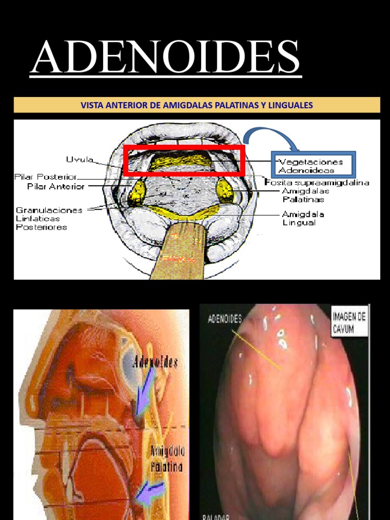 ADENOIDES | Enfermedades y trastornos | Medicina clínica