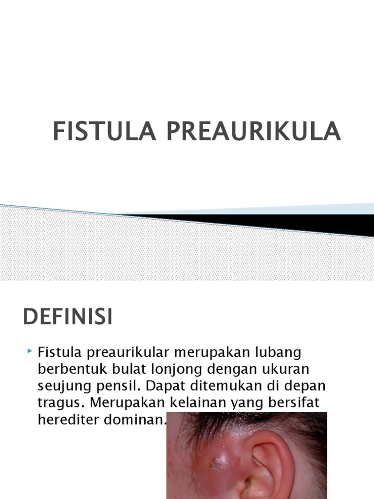 Fistula Preaurikular: A Congenital Abnormality of the Ear | PDF