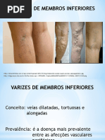 Resumo Varizes CEAP Corrigido | PDF