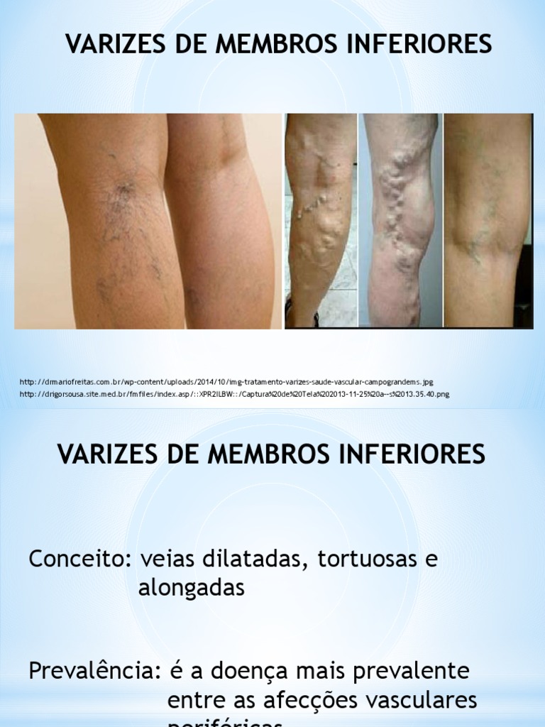 Varizes de Membros Inferiores e DVC 3 | Varicose Veins | Vein