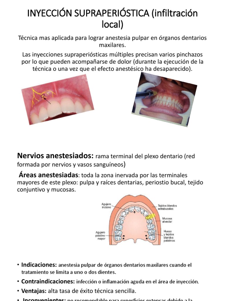 Inyección Supraperióstica (Infiltración Local) | Inyección (medicina ...