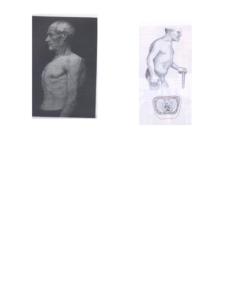 Torax en Tonel | PDF