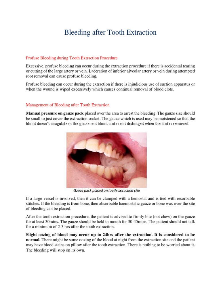Managing Bleeding After Tooth Extraction | PDF | Bleeding | Animal Anatomy