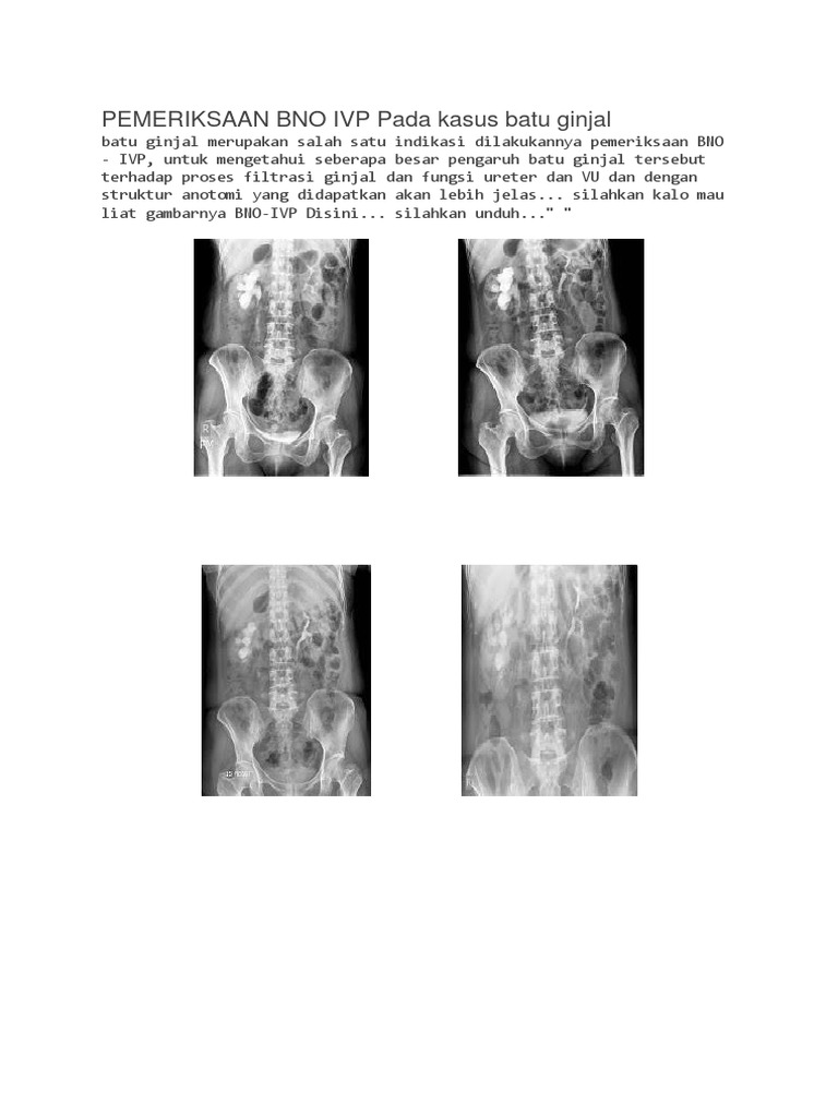 PEMERIKSAAN BNO IVP Pada Kasus Batu Ginjal | PDF