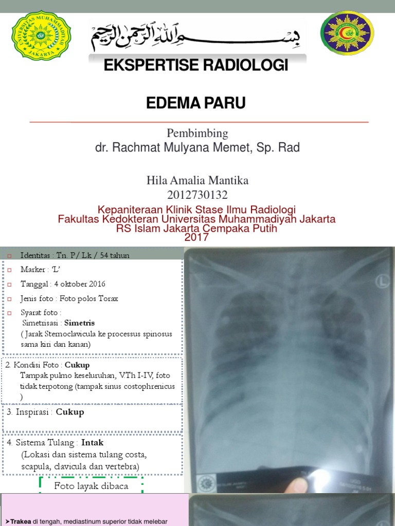 Edema Paru Radiologi | PDF