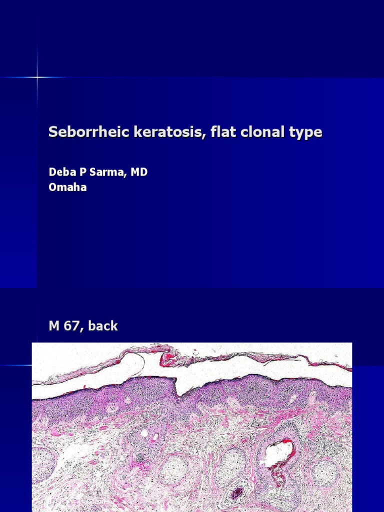 Seborrheic Keratosis Flat Clonal Type., M 67, Back | PDF