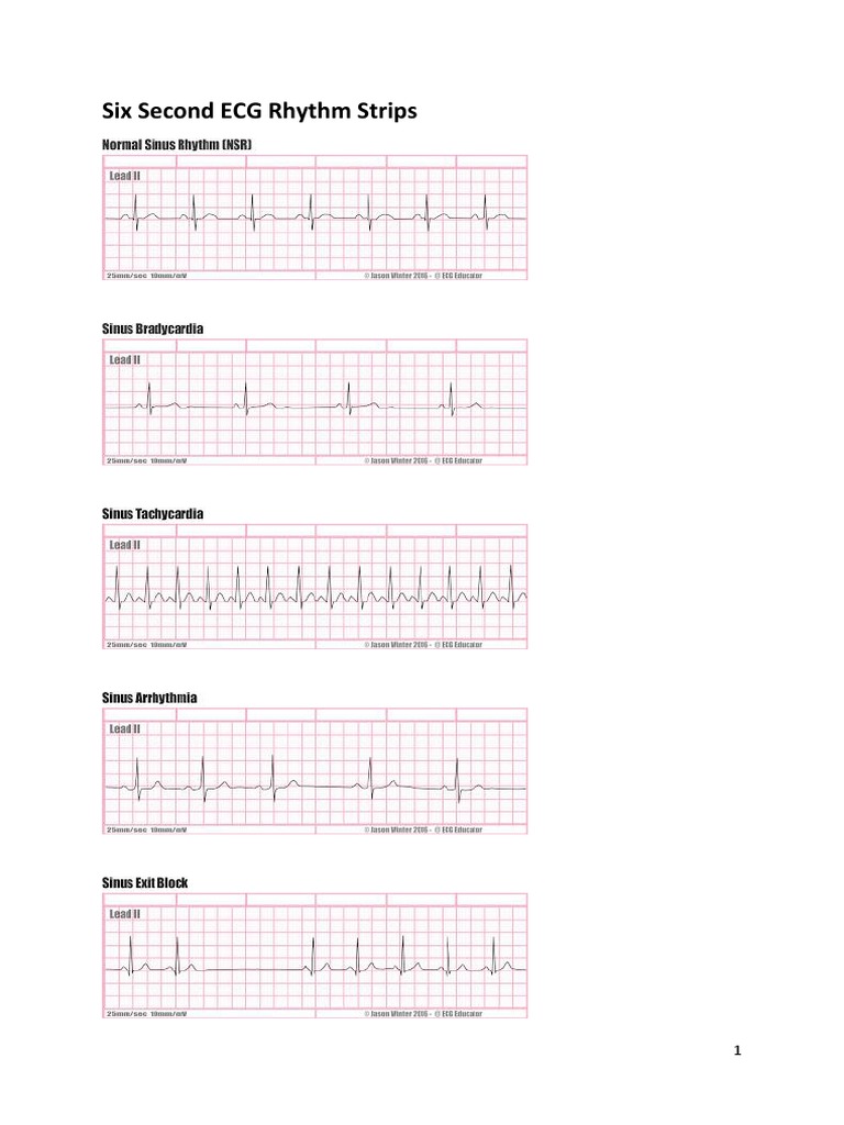 ECG Strips | PDF