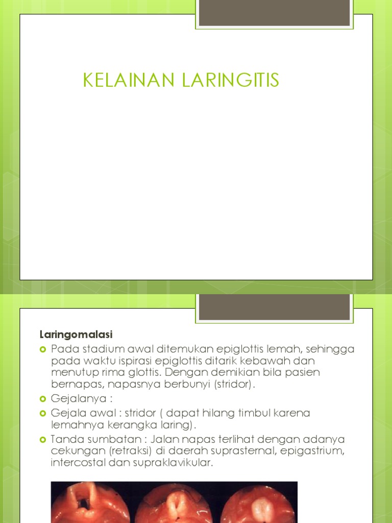 Laringitis Akut | PDF
