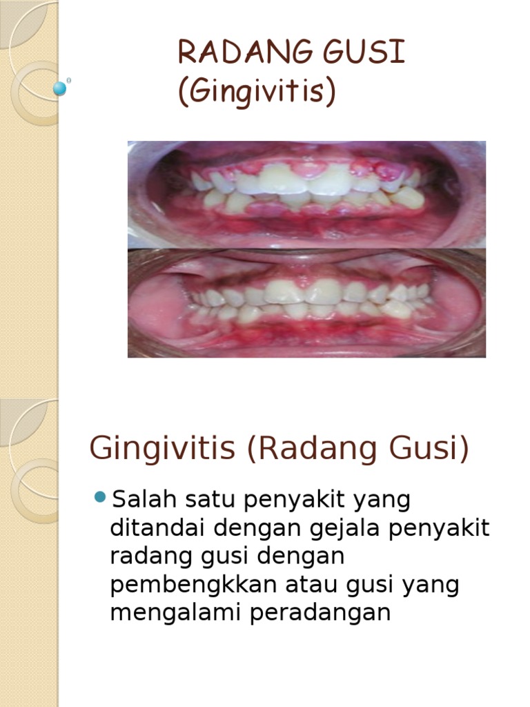 Radang Gusi | PDF | Kesehatan Holistik