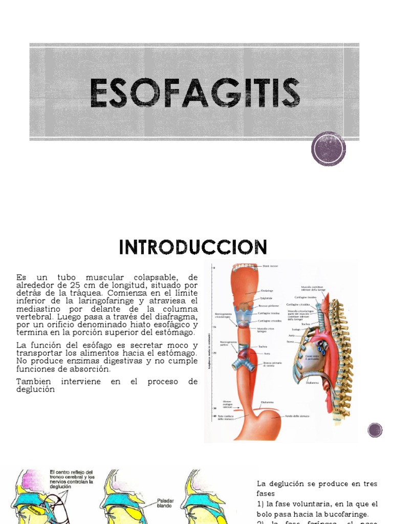 ESOFAGITIS | La enfermedad por reflujo gastroesofágico | Enfermedades y ...