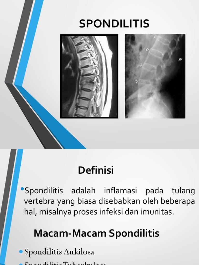 Spondilitis TB | PDF