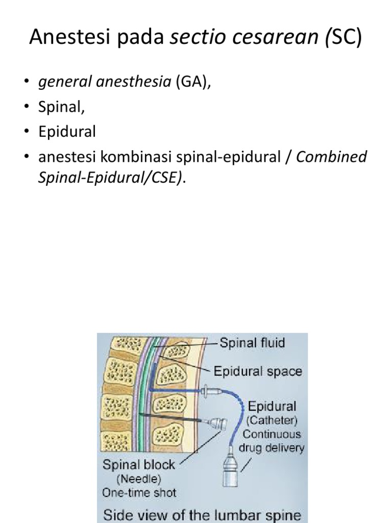 Anestesi Spinal untuk Sectio Caesarea | PDF