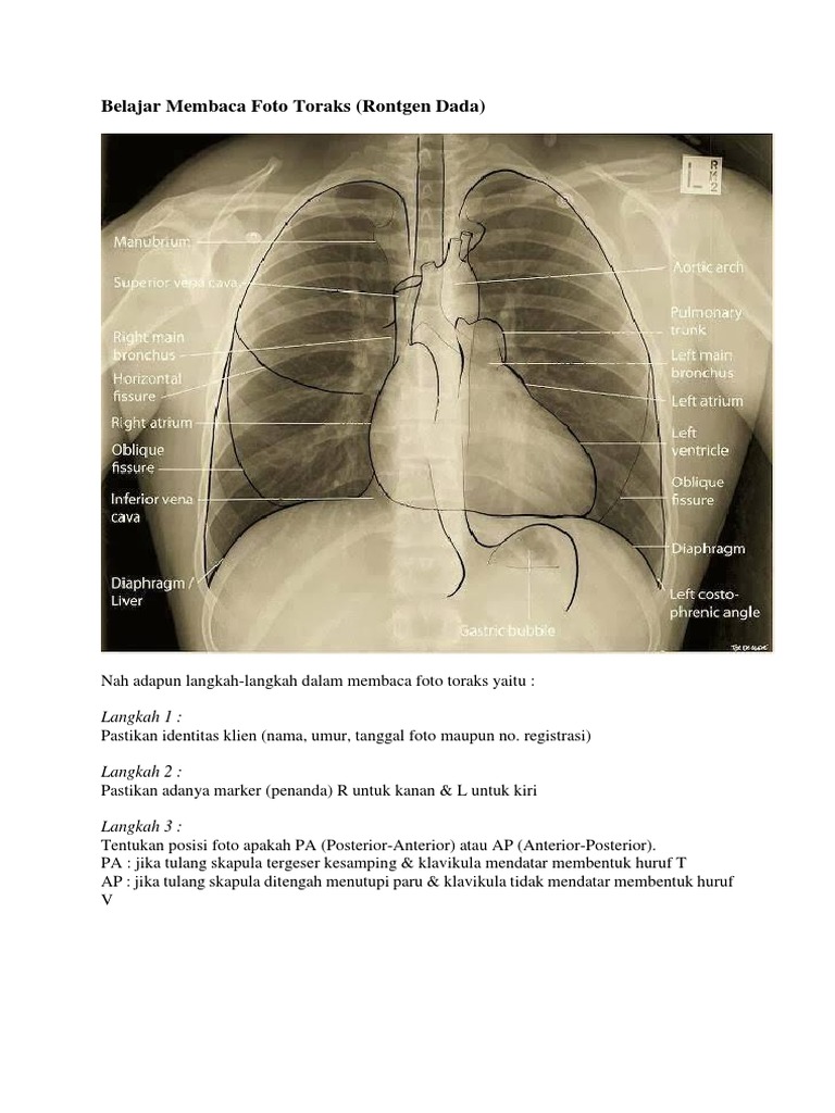 Belajar Membaca Foto Toraks | PDF