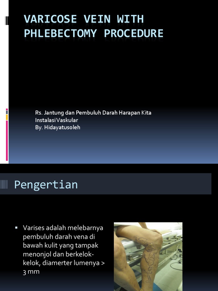 Varicose Vein With Phlebectomy Procedure | PDF